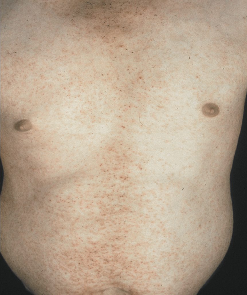 Scabies | Parasites without Borders