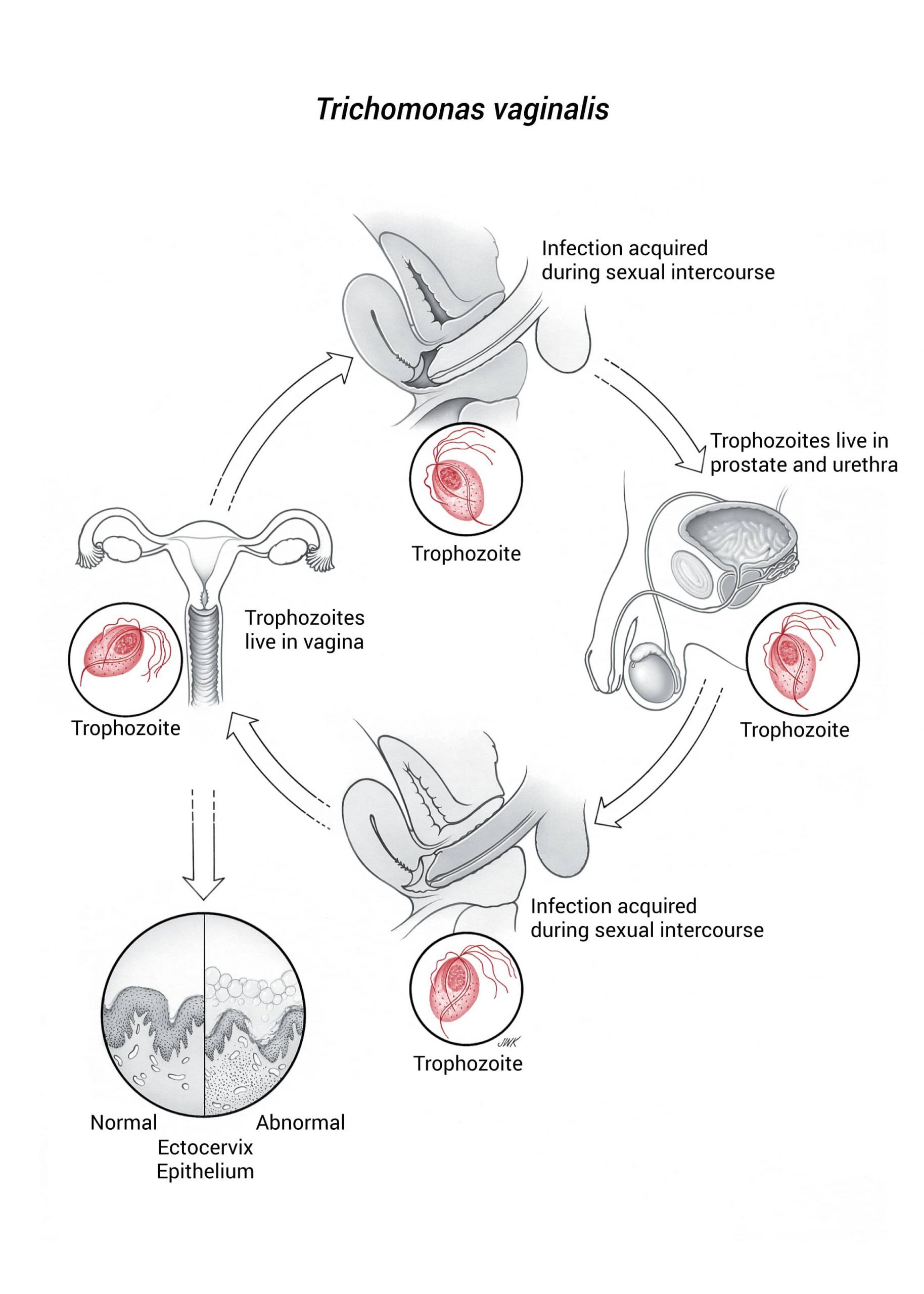 Trichomoniasis | Parasites without Borders
