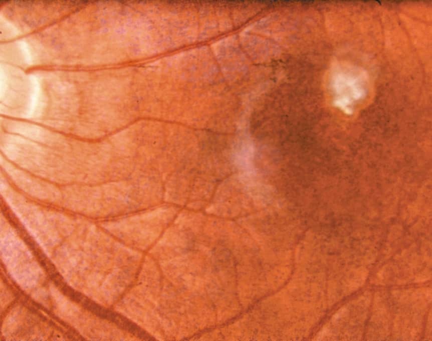 Zoonotic Nematodes | Parasites without Borders